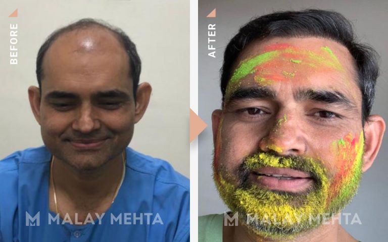 Best Hair Transplant in Mumbai | Dr Malay Mehta Hair Transplant Clinic