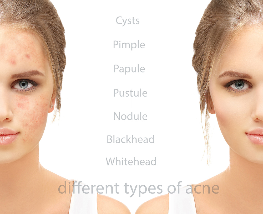 Blemishes Treatment | Dr. Malay Mehta in Mumbai